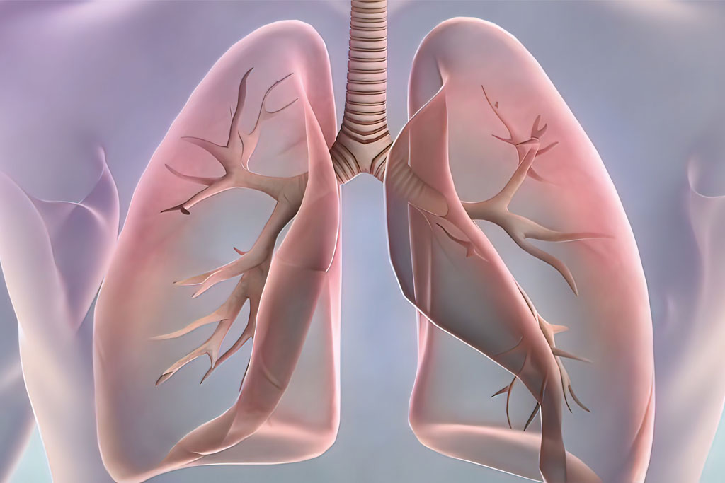 Pitkittyneitä keuhko-oireita? Sarkoidoosi oireilee monin tavoin - SuPer ...